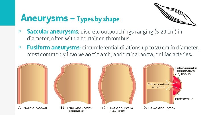 1 Aneurysms Dissections Ghadeer Hayel MD 29112020 Aneurysms