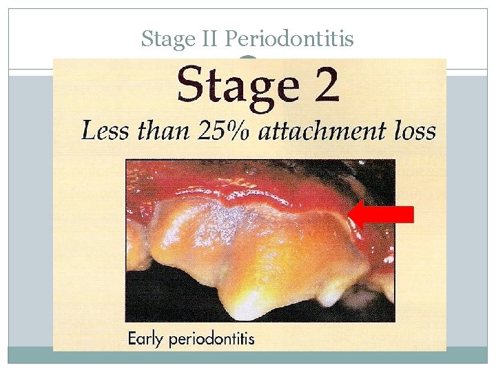 Periodontal Disease Normal Periodontium Remember which structures make