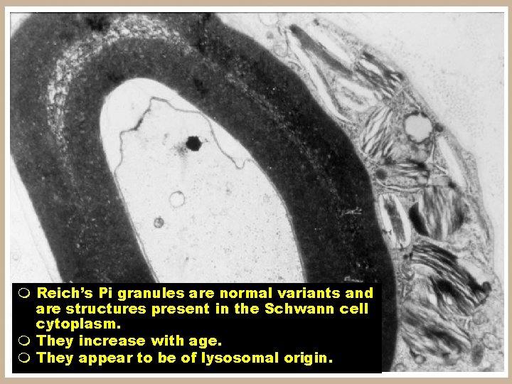 NERVE PATHOLOGY David Lacomis MD Nerve Biopsy m