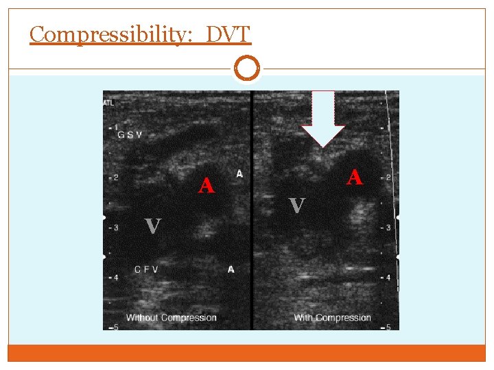 Deep Venous Thrombosis TURANDOT SAUL M D SEPTEMBER