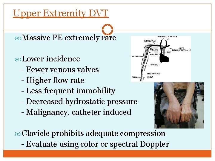 Deep Venous Thrombosis TURANDOT SAUL M D SEPTEMBER