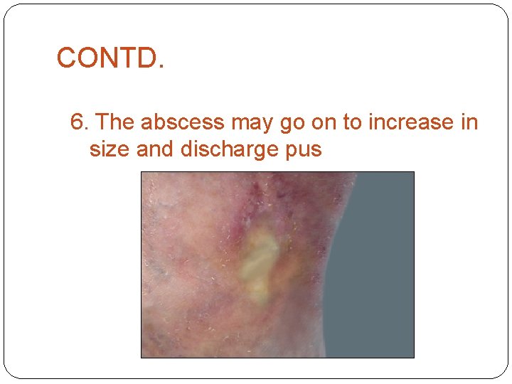 ABSCESS PREVENTION MANAGEMENT WHAT IS AN ABSCESS A