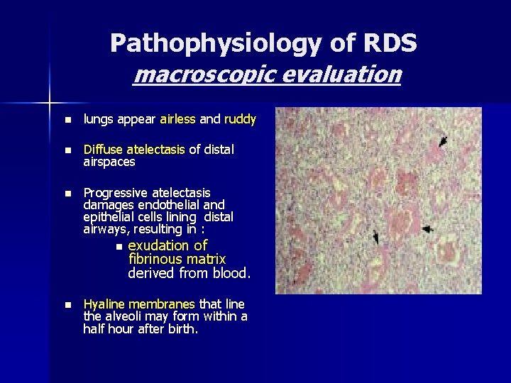 Respiratory Distress Syndrome or Hyaline Membrane Disease Dr