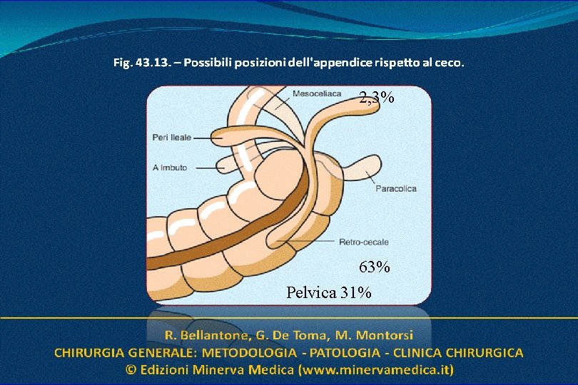 APPENDICITE ACUTA Riferimenti anatomici Base ceco Arteria appendicolare