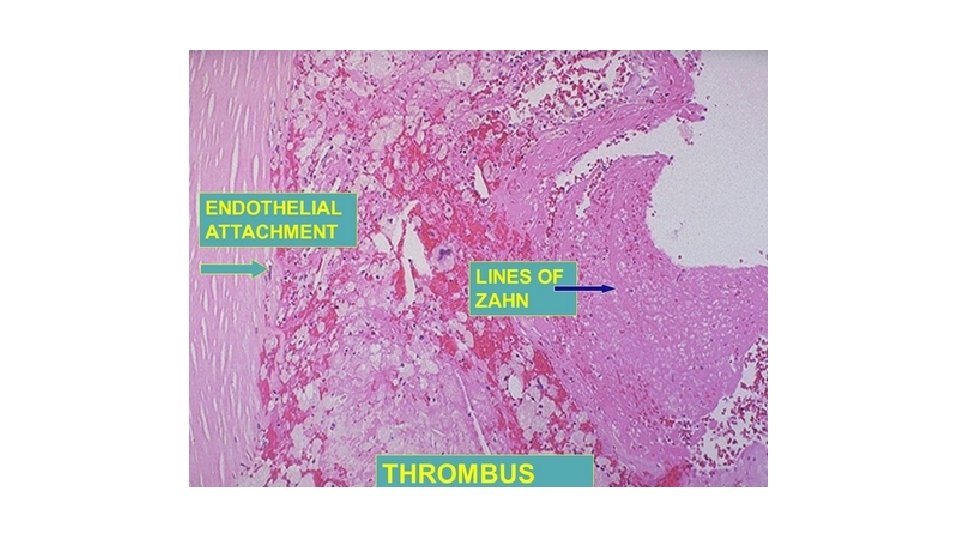 Thromboembolism and Shock Mural thrombi A Thrombus in