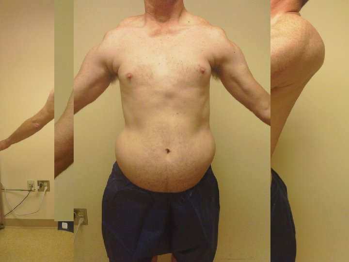 Limb Girdle Muscular Dystrophies Diagnosis and Treatment in