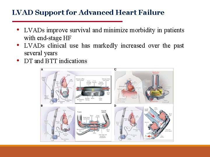 Arrhythmia Management in Patients With Left Ventricular Assist