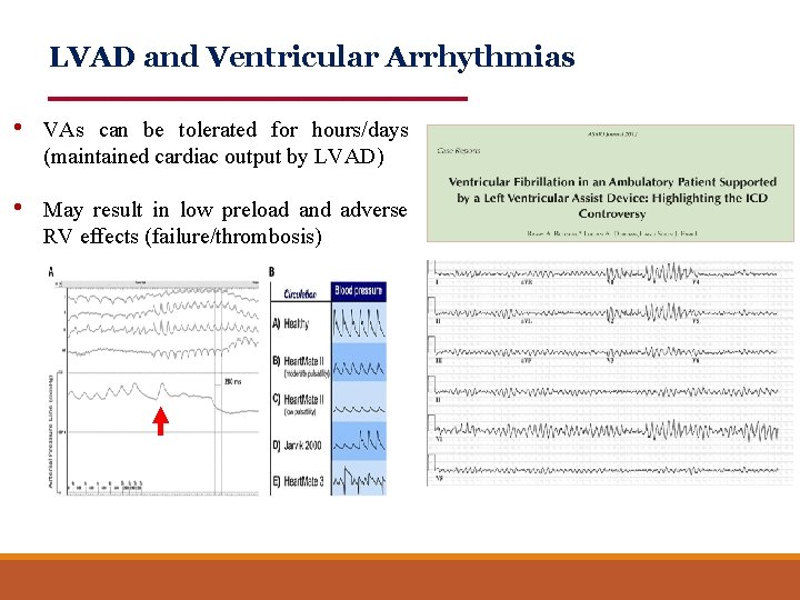 Arrhythmia Management in Patients With Left Ventricular Assist