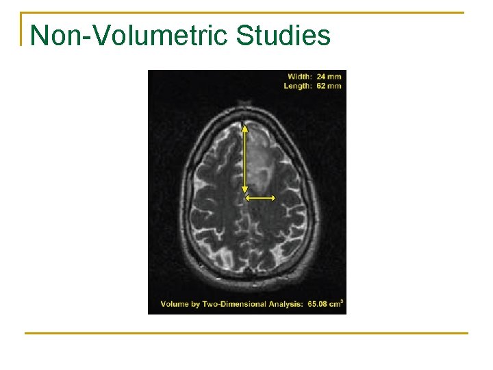 Multifocal Glioblastoma Multiforme Eric Wing Sun Tam The
