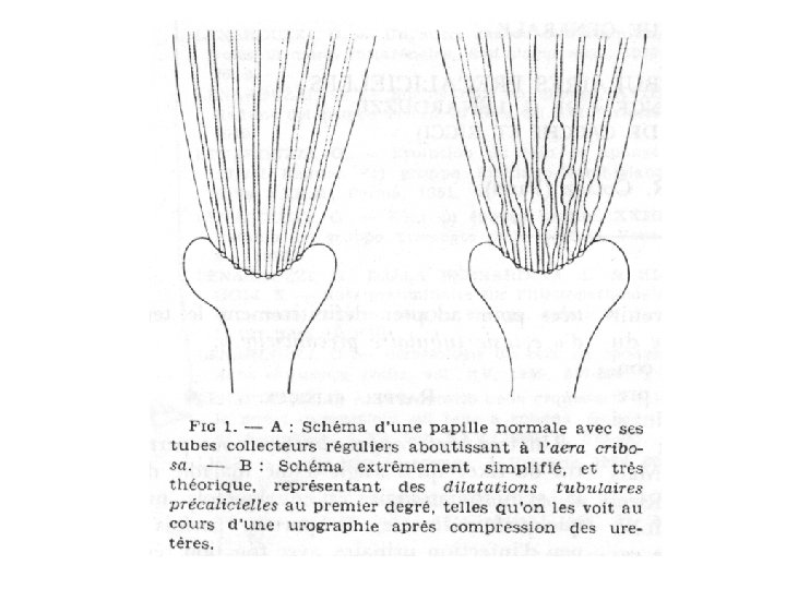 Rene policistico e Sclerosi tuberosa Sclerosi tuberosa Autosomica