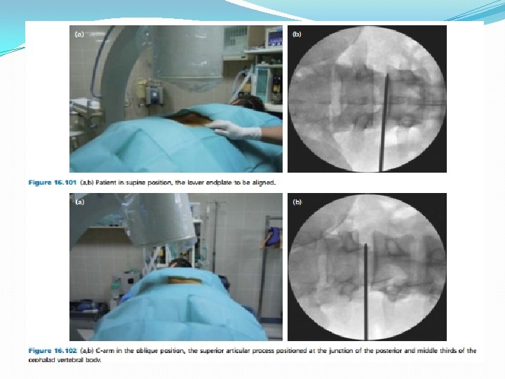 It has long been postulated that annular disruption