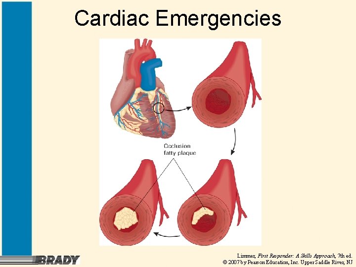 Chapter 14 Cardiac and Respiratory Emergencies Limmer First