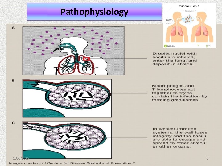 Tuberculosis Prof DR Waqar Al Kubaisy 1062019 1