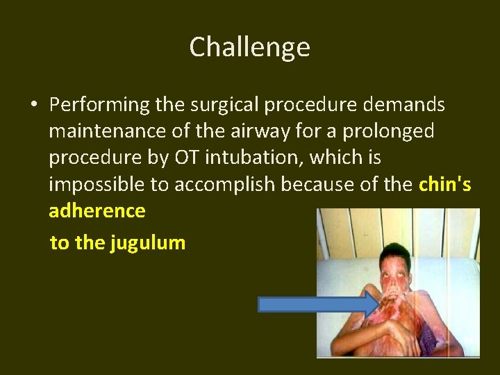 Post burns contracture neck anesthetic considerations Dr S