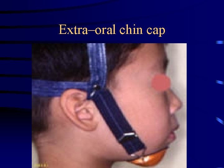 Fabrication of a toothborne mouthstick for a Quadriplegic