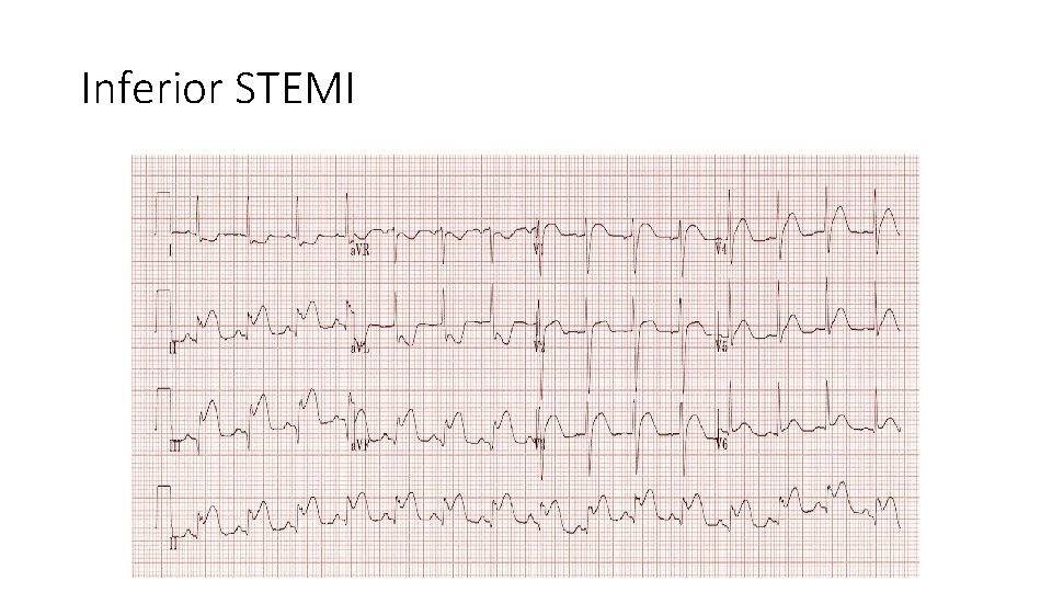 Tachycardia Broad Complex Regular Ventricular tachycardia Irregular ...