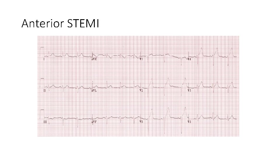 Tachycardia Broad Complex Regular Ventricular tachycardia Irregular ...