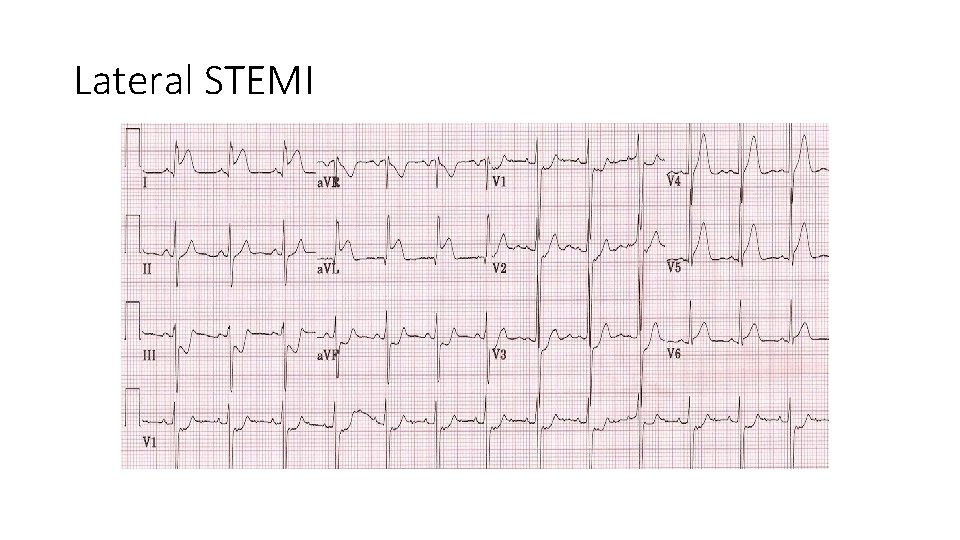 Tachycardia Broad Complex Regular Ventricular tachycardia Irregular ...