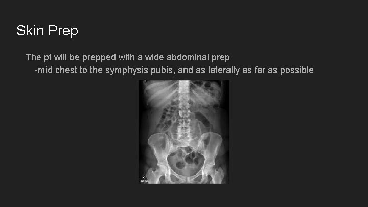 Hernia Repair TEP Incisional and Umbilical By Chayse