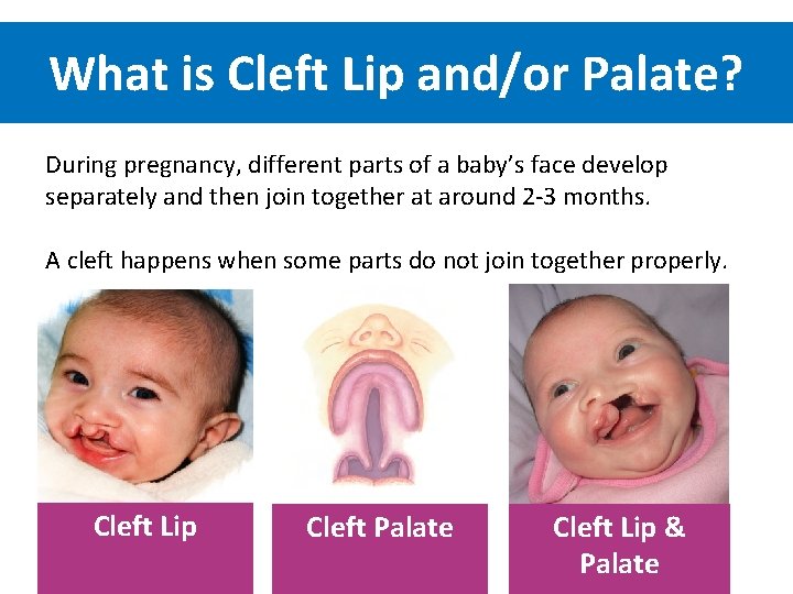 The Cleft Lip and Palate Association Your Name