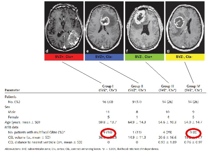 Multifocal Glioblastoma Multiforme Eric Wing Sun Tam The