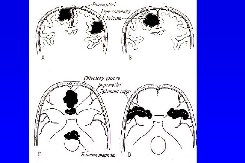 Brain Neoplasms General Considerations 1 Comprise 10 of