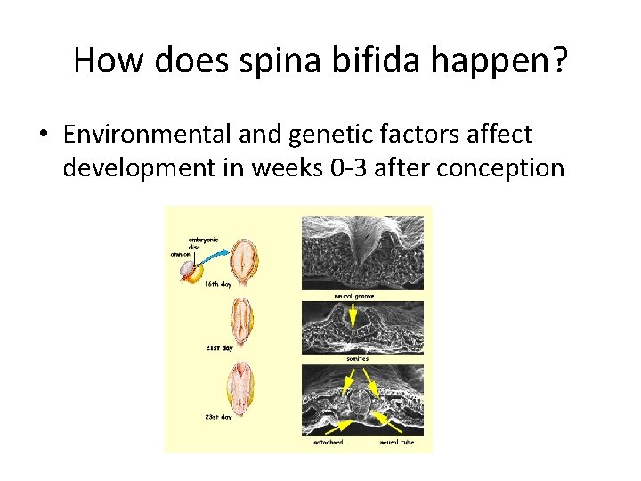 Spina bifida paediatric challenges Frances Gibbon Consultant Paediatric
