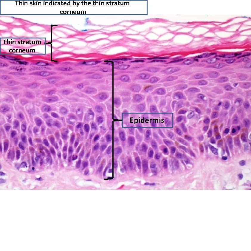 skin Thin skin indicated by the thin stratum