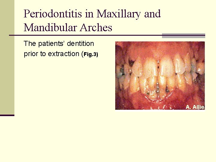 Oral Rehabilitation of a Patient with Chronic Periodontitis