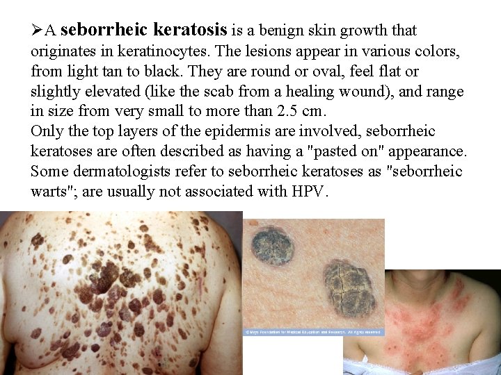 Skin cancer Melanoma Precancerous diseases Odessa National medical