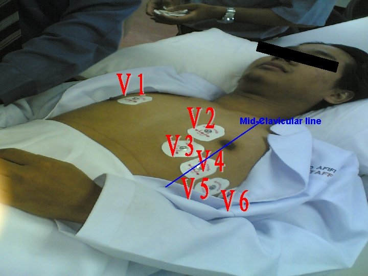 PRACTICAL 2 ELECTROCARDIOGRAM ECGEKG By Mohamad Azmir bin