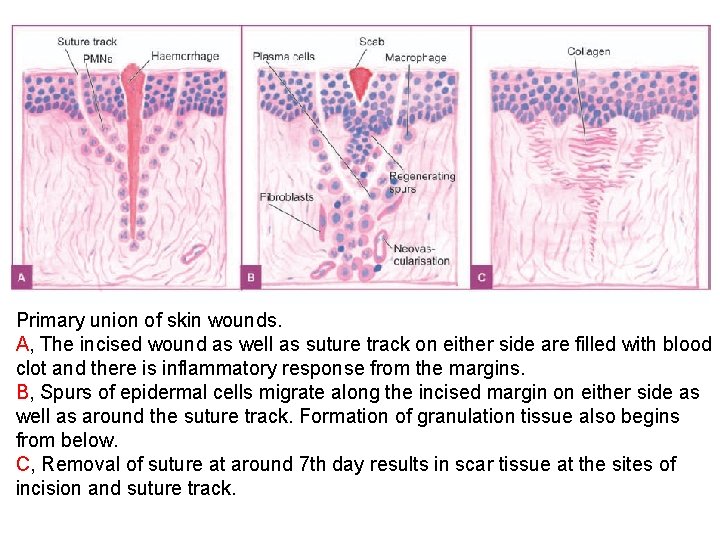 UNIT I Inflammation WOUND HEALING WOUND HEALING Healing