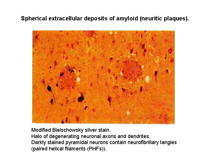 Spherical extracellular deposits of amyloid neuritic plaques Modified