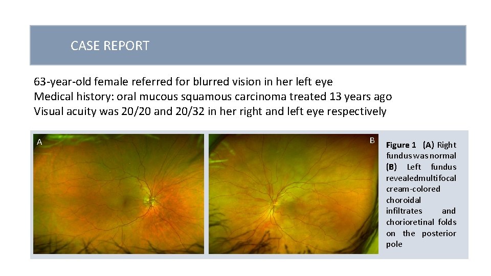 Ocular imaging in choroidal primary lymphoma a case