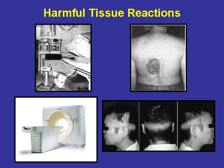 Interventional Radiology Doses Walter Huda Ph D Radiology