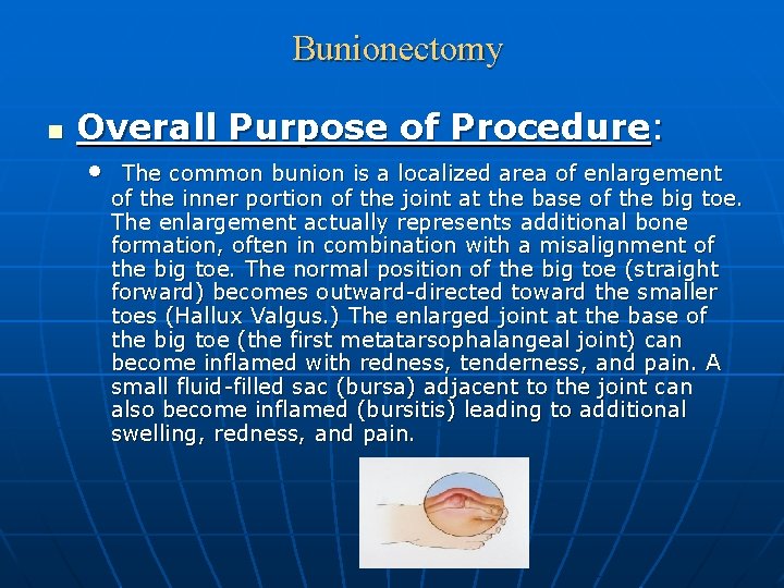 Orthopedic Procedures Operative Sequence Bunionectomy Foot Anatomy Foot