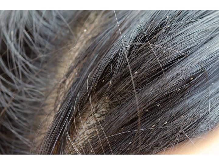 Pediculosis and Scabies Pediculosis Pediculus humanus capitis head