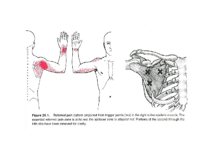Chronic Scapulothoracic Pain or Chronic Shoulder Pain Steve