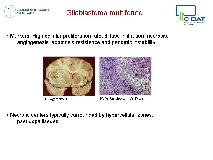 Epigenetics in glioma HKS Tumore MGMT ABCB 1