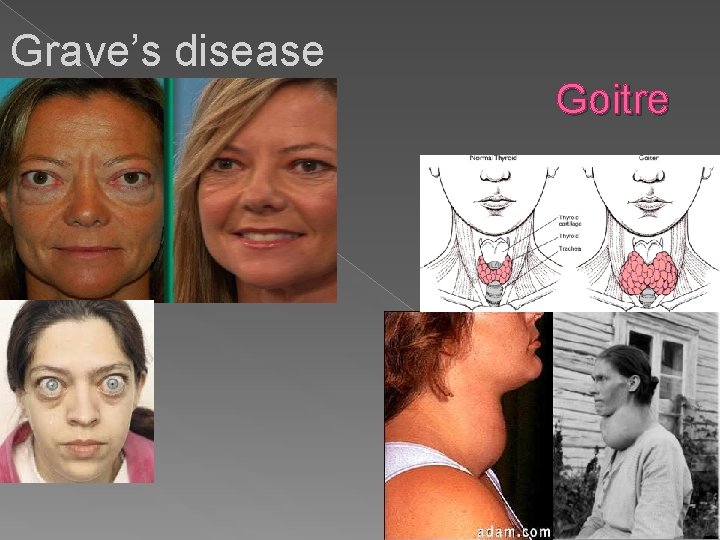 Disorders of the Endocrine System Thyroid Gland Hormone