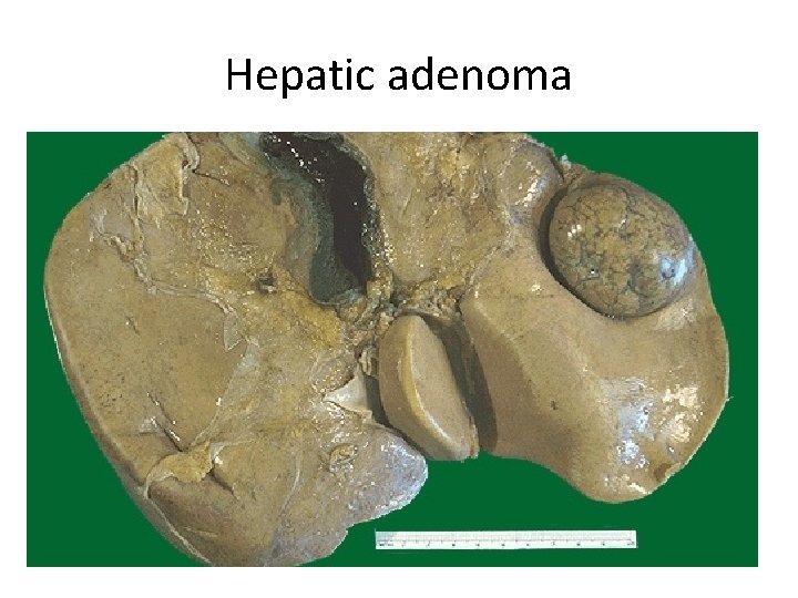 HEPATOBILIARY SURGERY LIVER K Winczakiewicz Anatomy of the