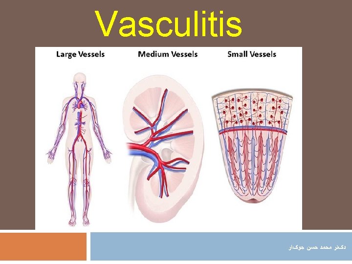 SMALL VESSEL VASCULITIDES Classification ANCAASSOCIATED VASCULITIS ...