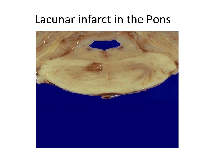 Cerebrovascular diseases2 Primary angiitis of CNS Other causes