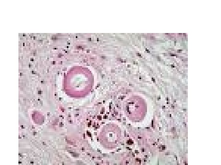Cerebrovascular diseases2 Primary angiitis of CNS Other causes