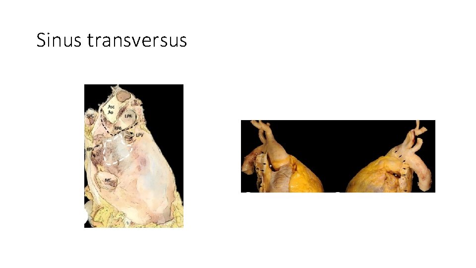 Perikard Anatomie des Herzbeutels Cavum pericardiale Perikard Lamina