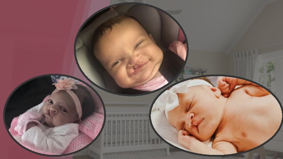 FETAL FACE NECK ANOMALIES BY AMANDA MEADOWS DMS