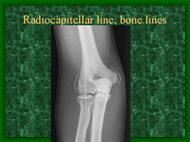 Skeletal Injuries of the Elbow Forearm and Wrist
