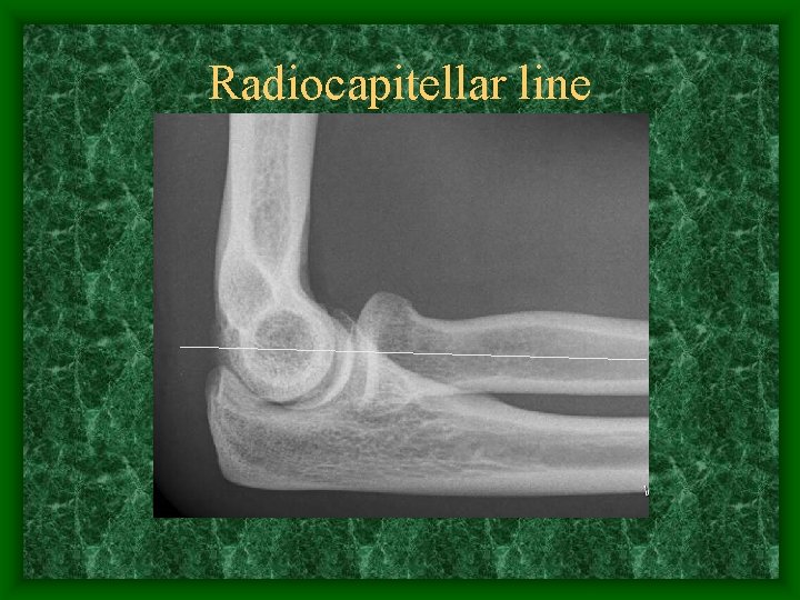 Skeletal Injuries of the Elbow Forearm and Wrist