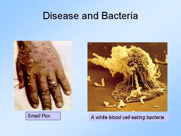 Disease and Bacteria Small Pox A white blood