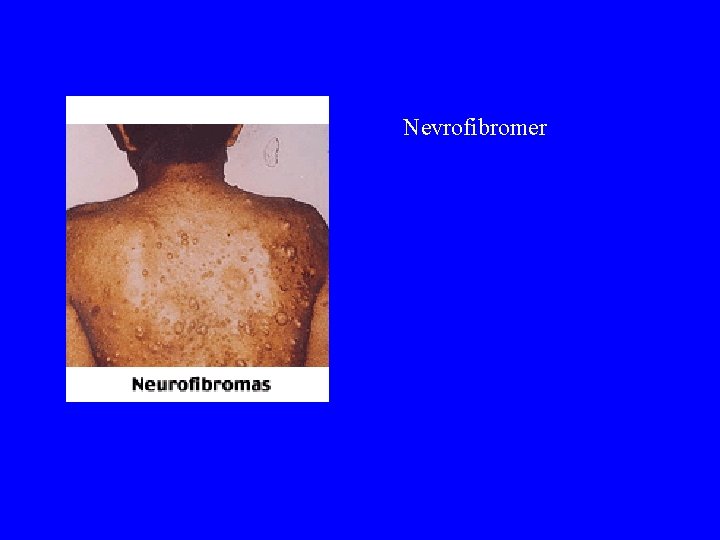 Nevrofibromatose type 1 NF 1 og Nevrofibromatose type